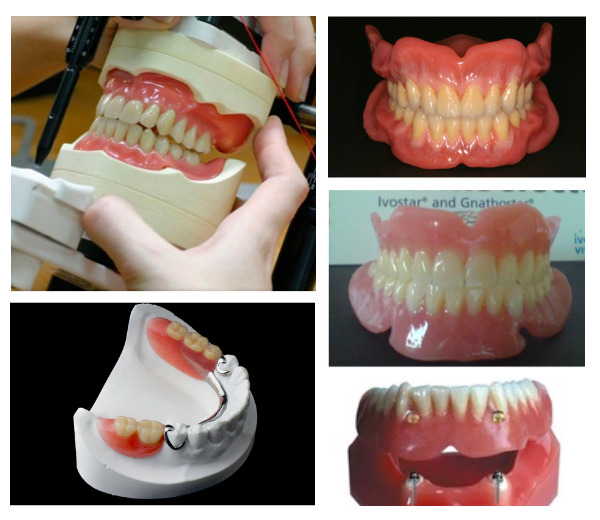 Fogsor javítás Zugló, fogsor készítés 14. kerület